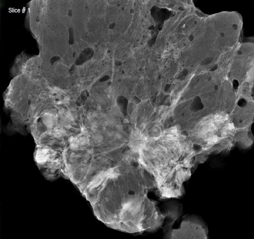 Radial Scars and Invasive Breast Cancer