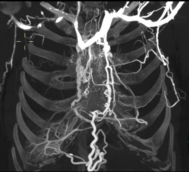 SVC Occlusion with Portal Vein Collaterals