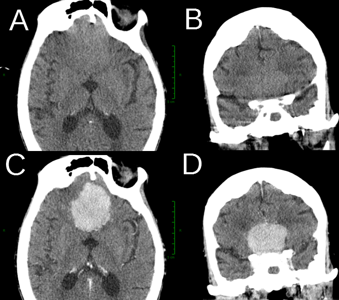 Planum Sphenoidale Meningioma