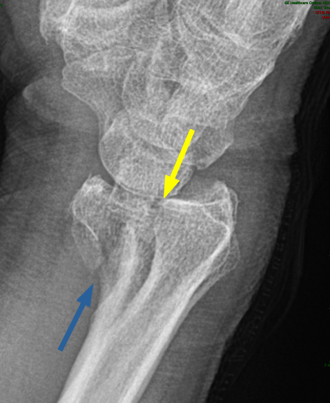 Smith Fracture