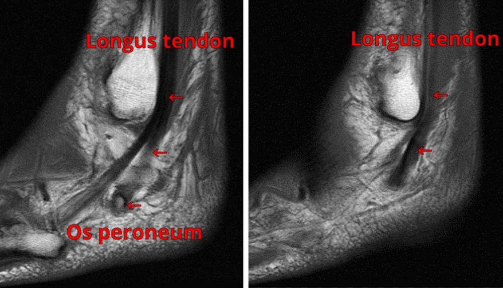 Painful Os Peroneum Syndrome (POPS)