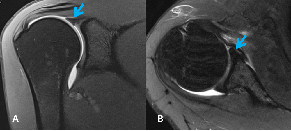 Imaging Glenohumeral Instability: What the General Radiologist Should Know