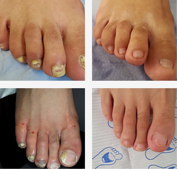 How To Recover From A Toenail Removal?