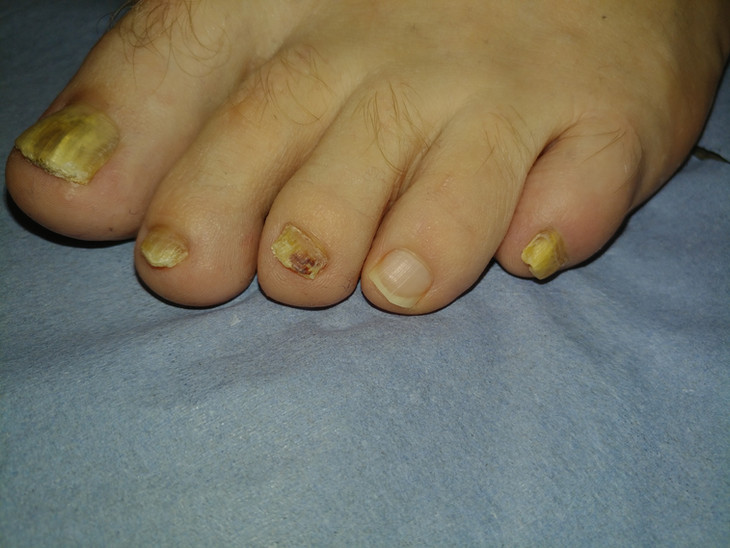 Thickened and Overgrown Nails | Fungal Laser Nail Surgery Specialist ...