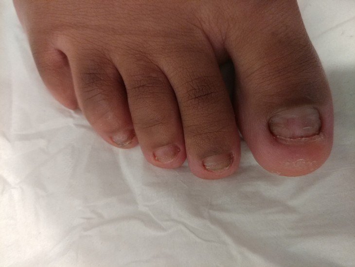 Thickened and Overgrown Nails | Fungal Laser Nail Surgery Specialist ...