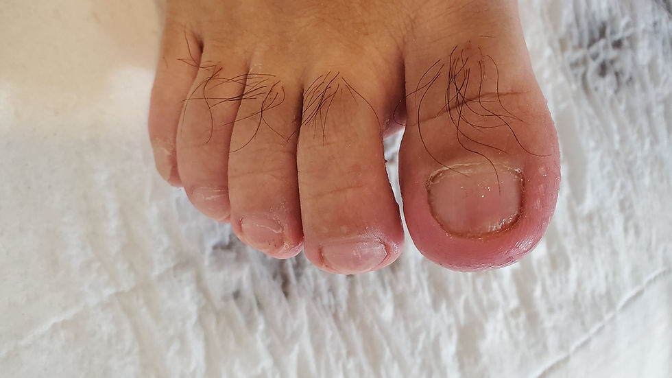 Lunula Laser For Effective Fungal Toenail Treatment In London