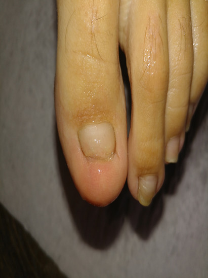 Green Nail Pseudomonas Infection | Fungal Laser Nail Surgery Specialist ...