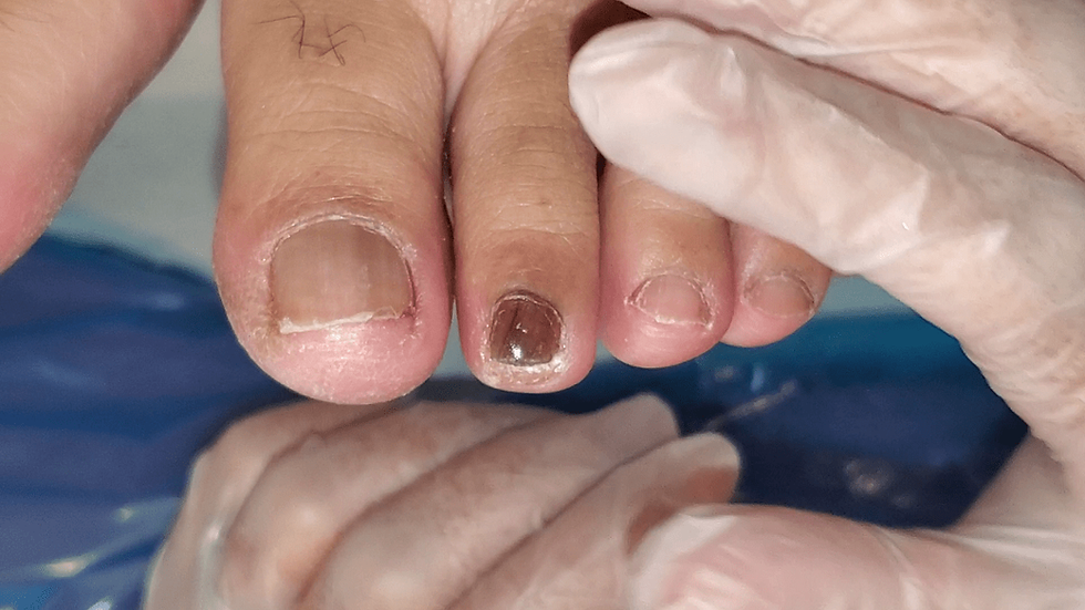 What are Some Common Toenail Injuries in Athletes?