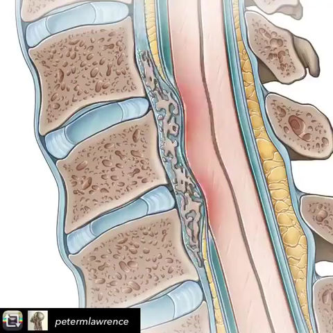 Cervical Myelopathy by OPLL / C4 & C5 Corpectomy and anterior posterior ...