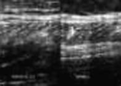 Rabdomiolisi e Sindrome Compartimentale: utilizzo delle tecniche di imaging