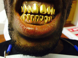 Halogolds | Gold Crown | Gold Teeth | Orlando Dentist