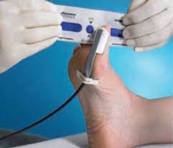 No, Skin Perfusion Pressure Cannot Replace Transcutaneous Oximetry in ...