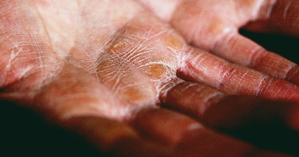 Dry, Cracked Winter Hands