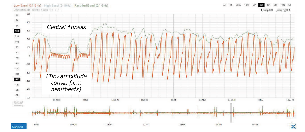 SLEEP APNEA SCORING | EMFIT SENSORS
