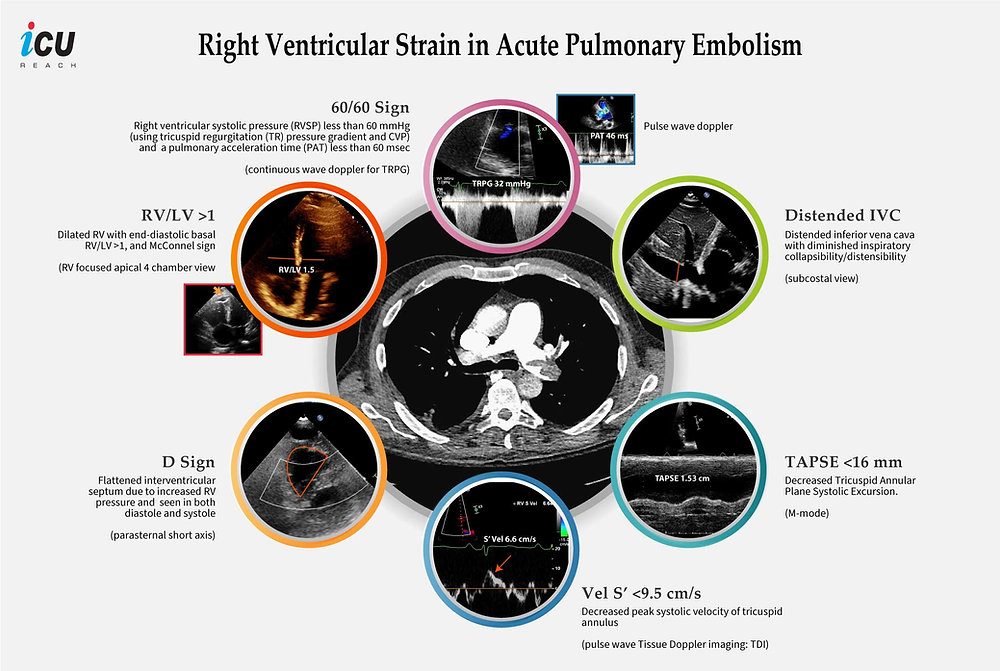 Echocardiographic Signs of Right Ventricular Strain in Acute Pulmonary ...