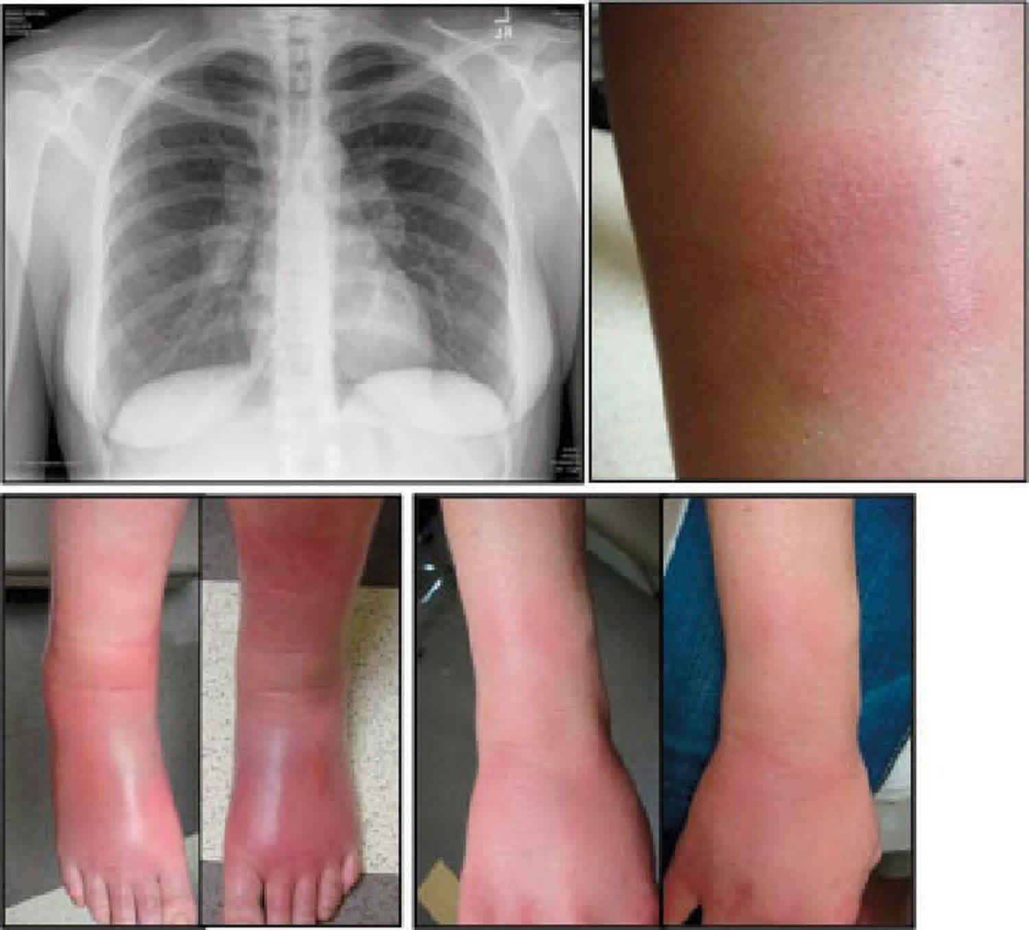 Löfgren syndrome is a type of acute sarcoidosis an inflamma | Internal ...