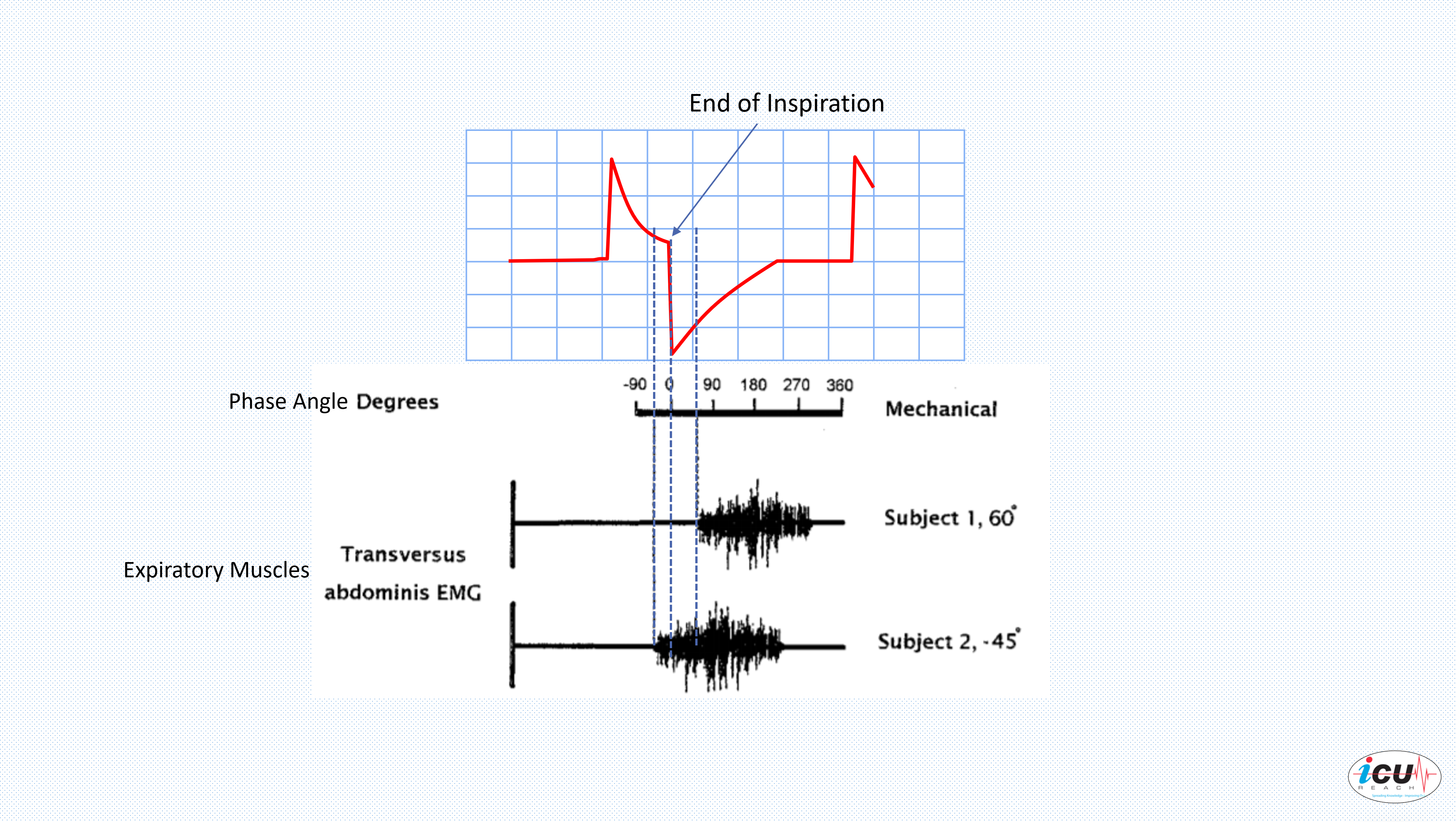 Cycling asynchrony on the ventilator assessed by expiratory ...