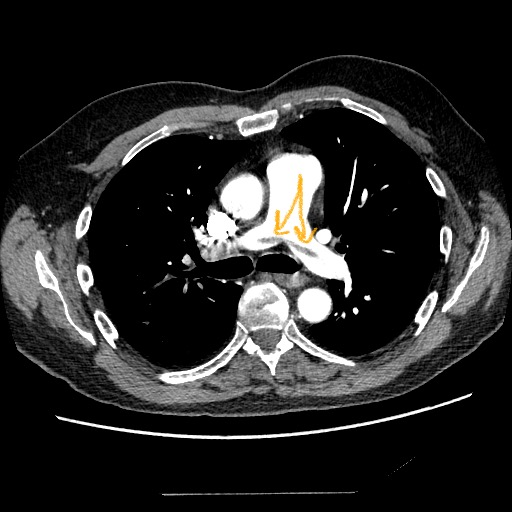Live PERT Discussion in the Management of Pulmonary Embolism Cases ...