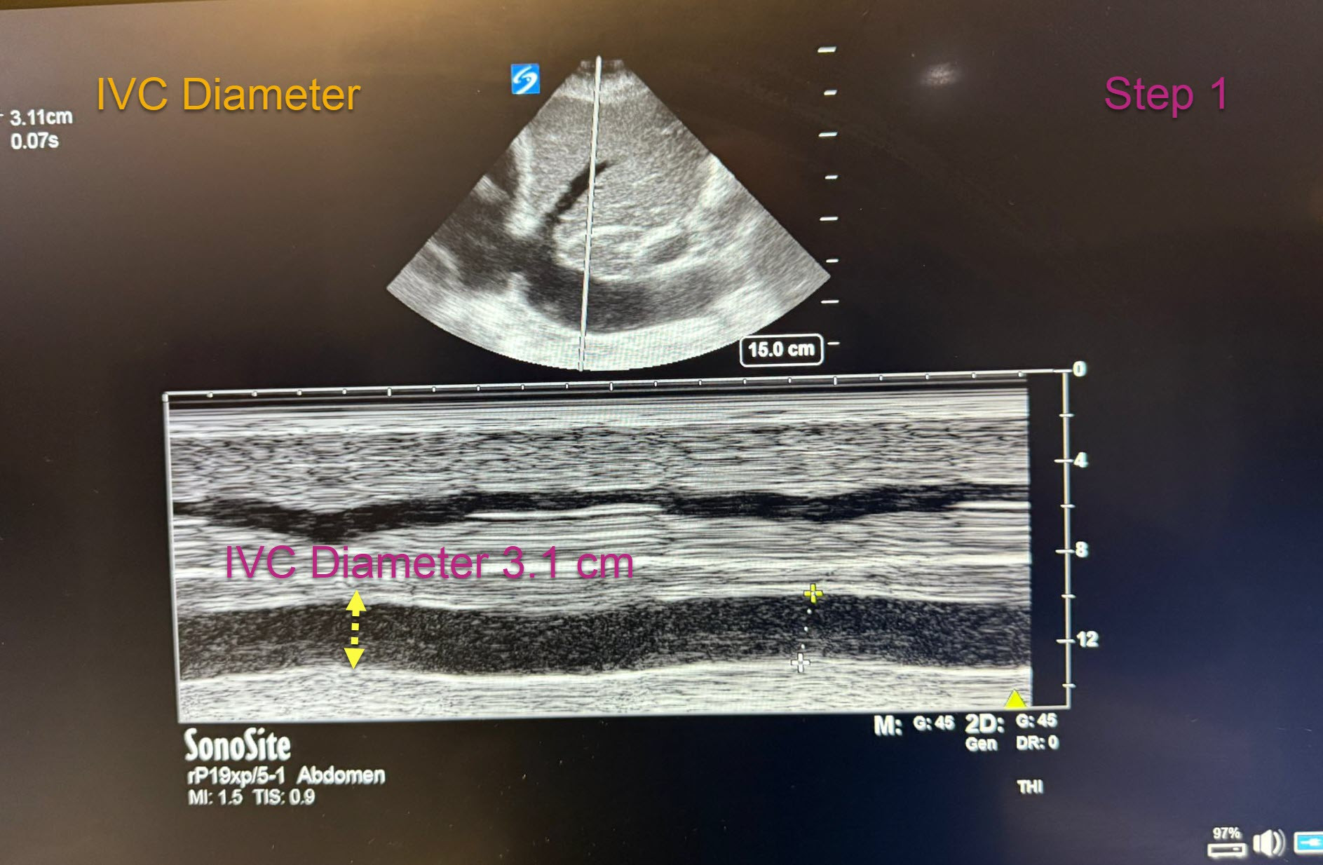 Understanding the VExUS Score: A Case Example of Grade 3 Congestion