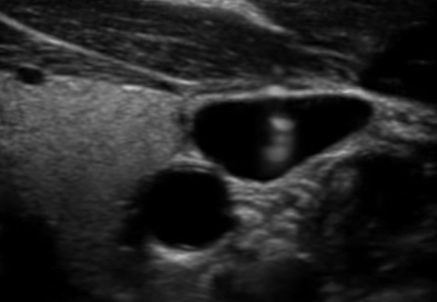 Ultrasound-Guided CVC: Biplane vs. Single-Plane Approaches
