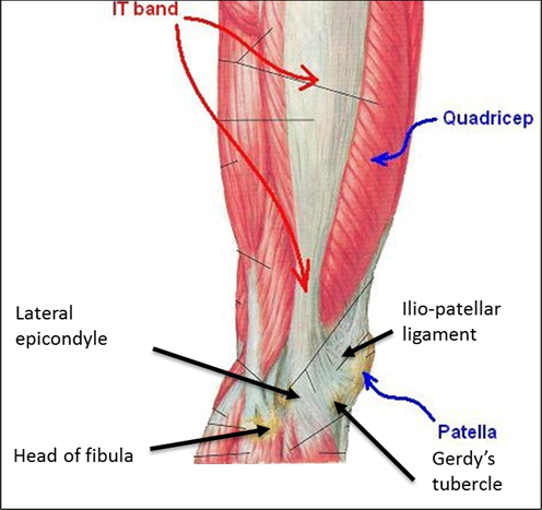 ITBS = Iliotibial Band Syndrome