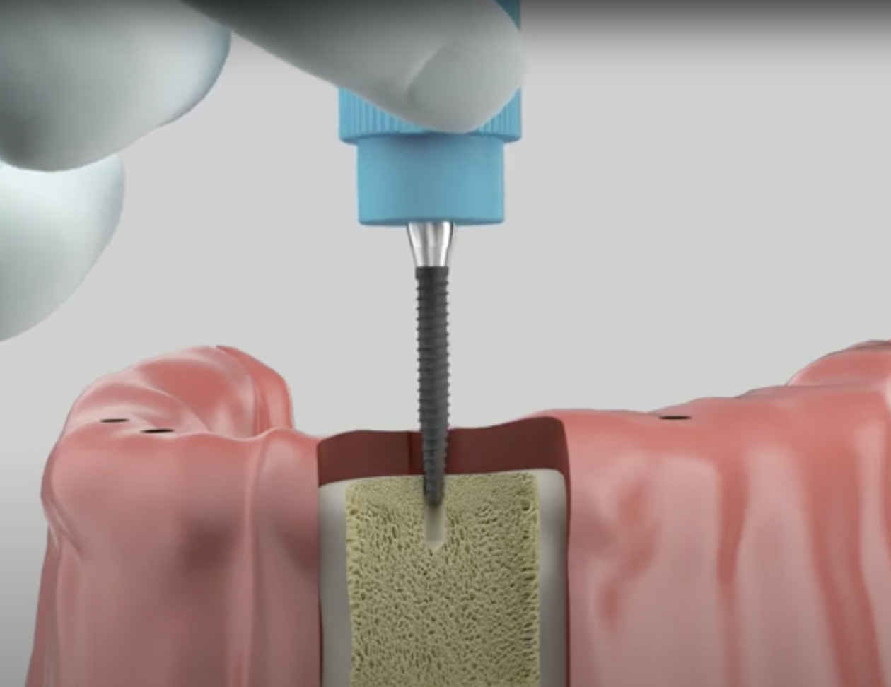 Osseo Group - The home of small diameter implants.