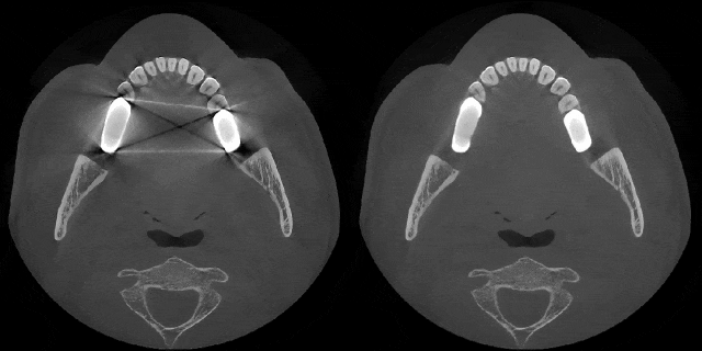 PD-MAR: The Ultimate Solution to CBCT Artefacts