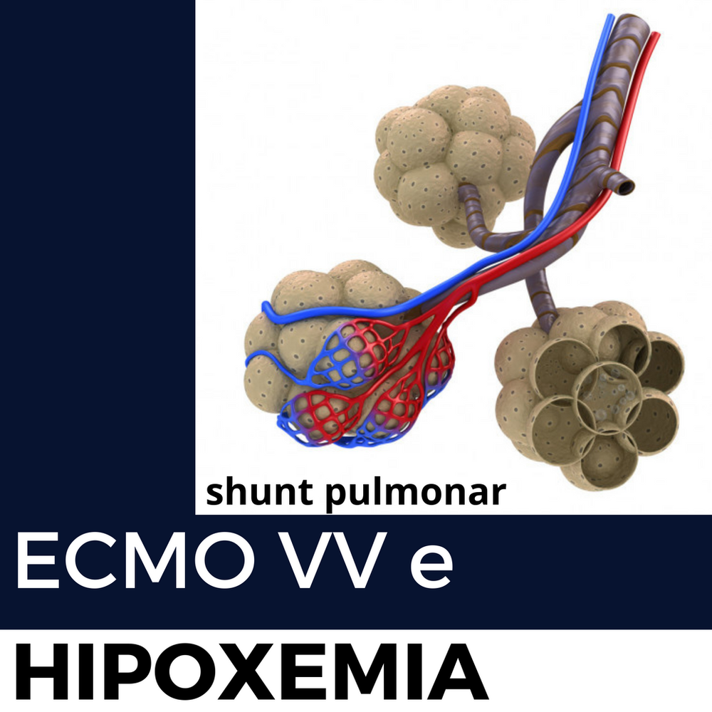 Shunt pulmonar e hipoxemia na ECMO VV: o racional e a conduta.