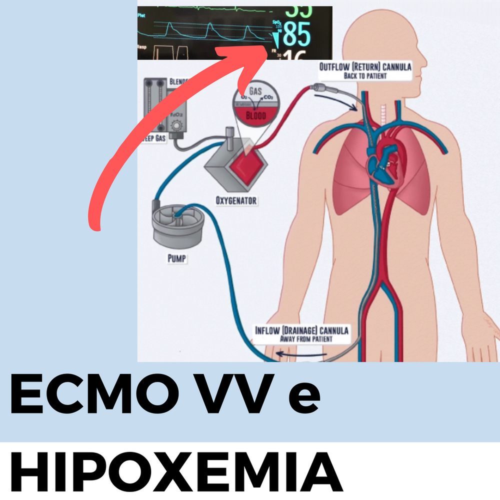 Hipoxemia severa durante ECMO venovenosa: quais são as principais causas?