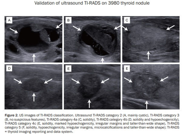 TI-RADS classification had great diagnostic value in diagnosing thyroid ...