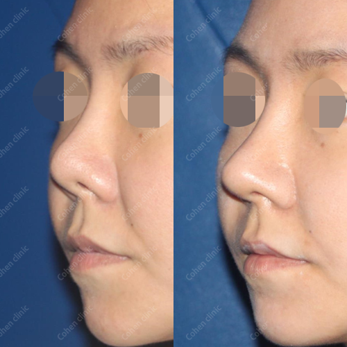 Closed rhinoplasty + contracted nose + upturned nose + columella ...