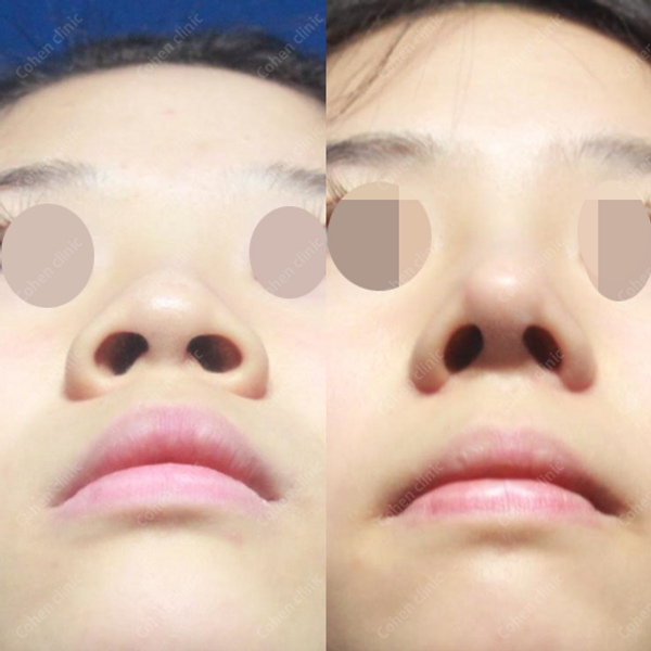 Closed rhinoplasty + alarplasty + bulbous nose + flat nose
