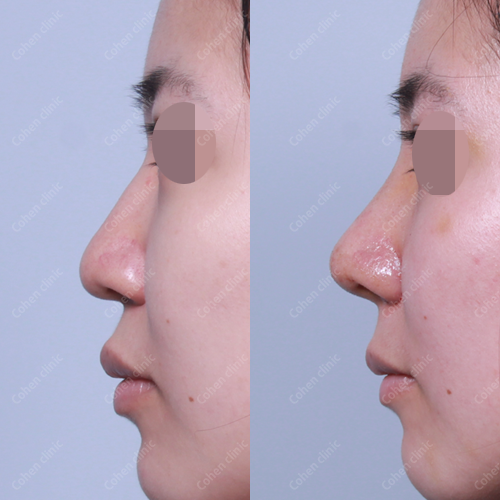 Closed rhinoplasty + bulbous nose + droopy nose + flat nose + alar ...