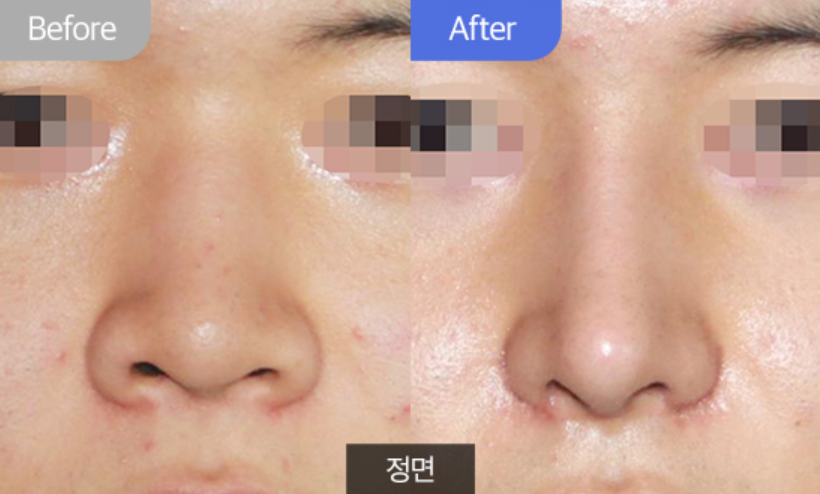 Closed rhinoplasty + bulbous nose + flat nose + columella extension ...