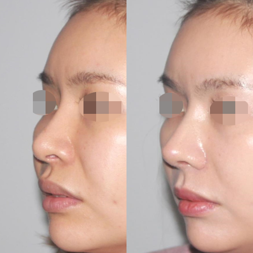 Closed rhinoplasty + bulbous nose + columella corection + nasolabial ...