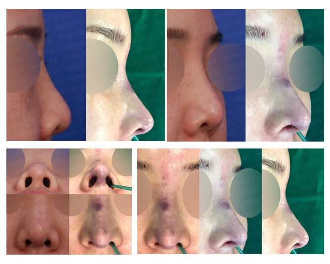 short nose + upturned nose + columella lengthening + autologous costal ...