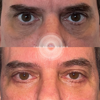 Periorbital Fat Grafting | Dr. Emily Bratton