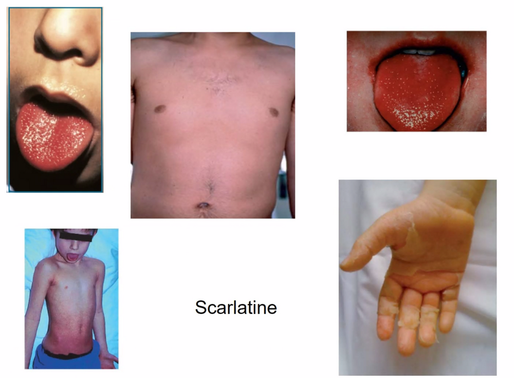 Scarlatine = langue framboisée