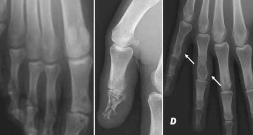 Dactylite (Psoriasis, Sarcoïdose) = radis