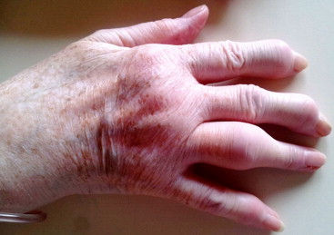 Dactylite (Psoriasis, Sarcoïdose) = radis