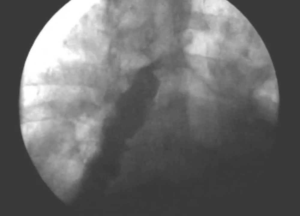 What is a Corkscrew Esophagus?