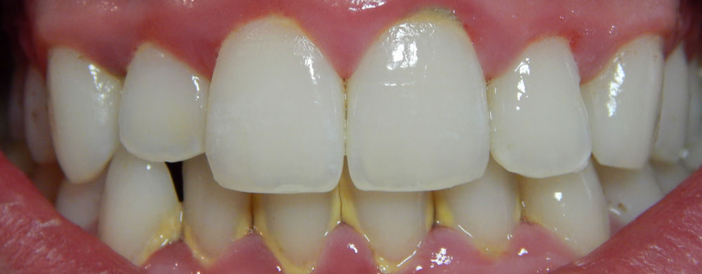 11 passos para avaliar sua gengiva