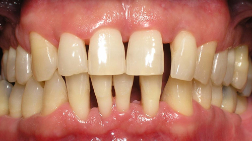 11 passos para avaliar sua gengiva