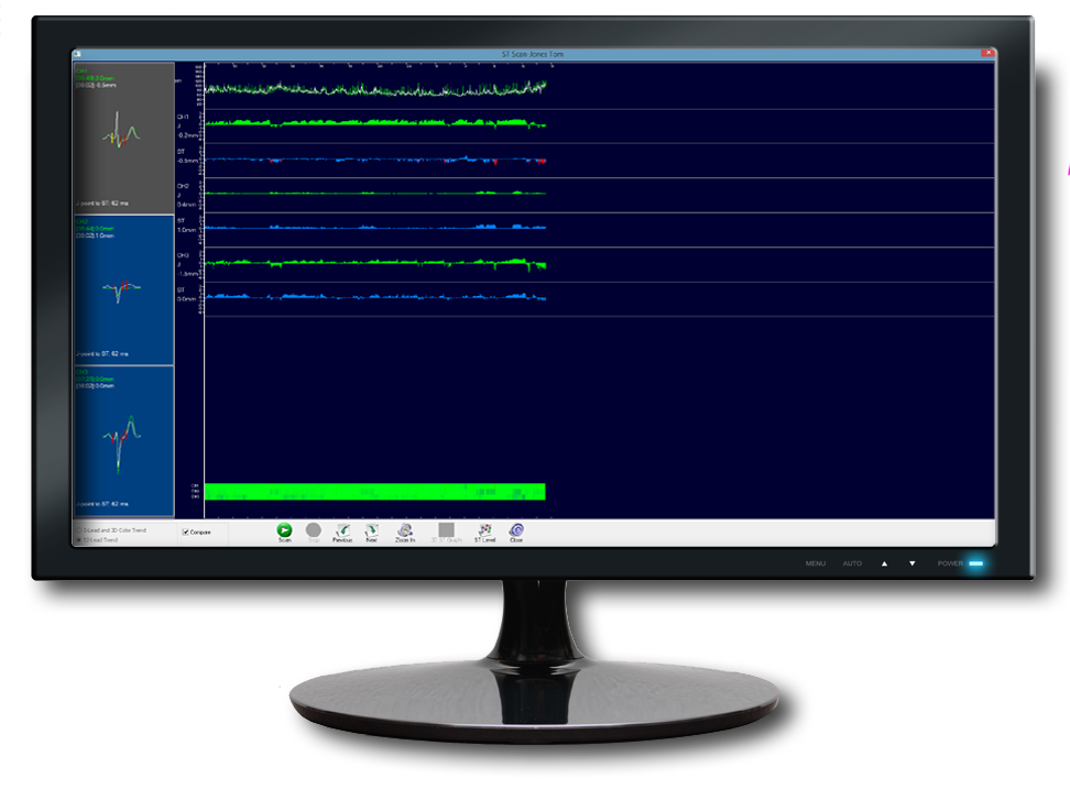 CardioScan Holter Analysis Software-Cardiac Event Software