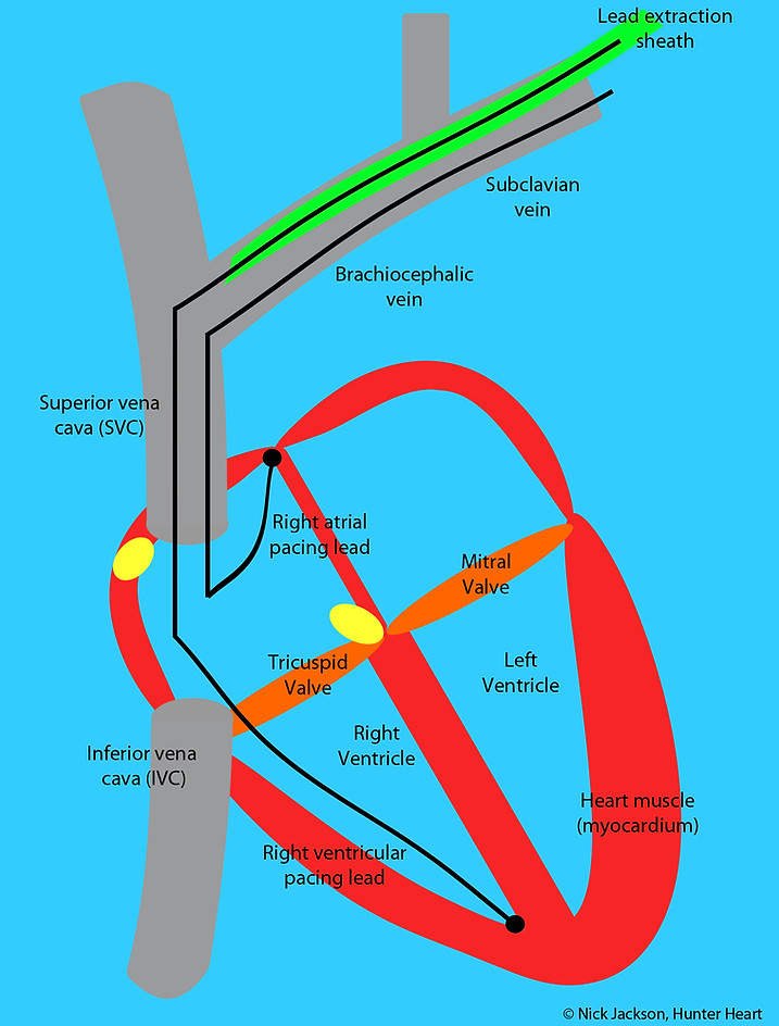 Lead Extraction | Hunter Heart