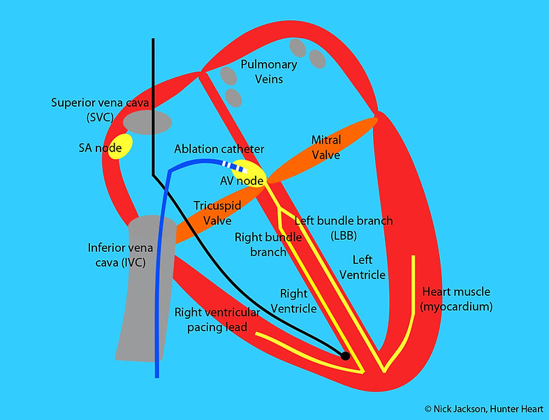 AV node ablation (and Pacemaker Implant) | Hunter Heart