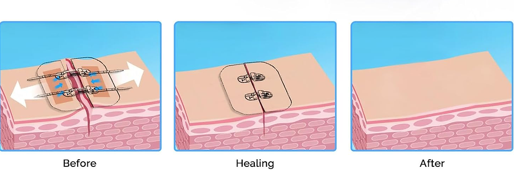Stitches Without the Scars: A New Approach to Facial Wound Closure