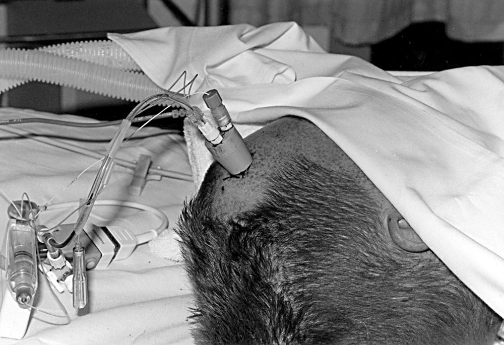 Microdialisis Cerebral: Valiosa tecnica en el paciente neurocritico.