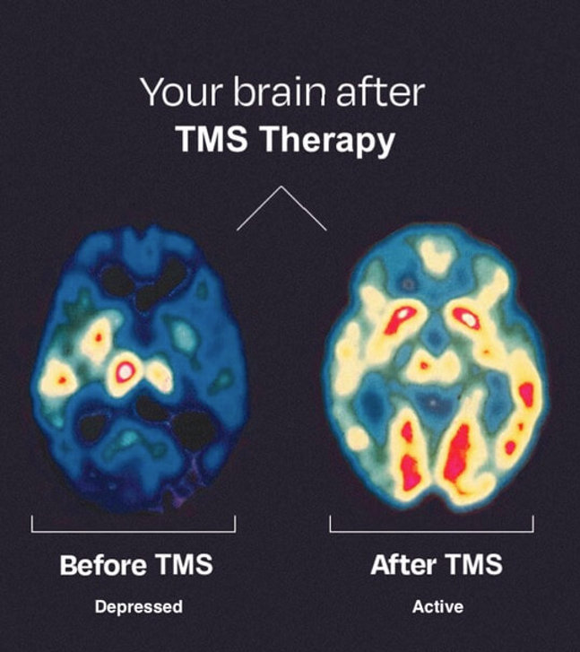 TMS Is Not Shock Therapy (ECT): Understanding the Key Differences
