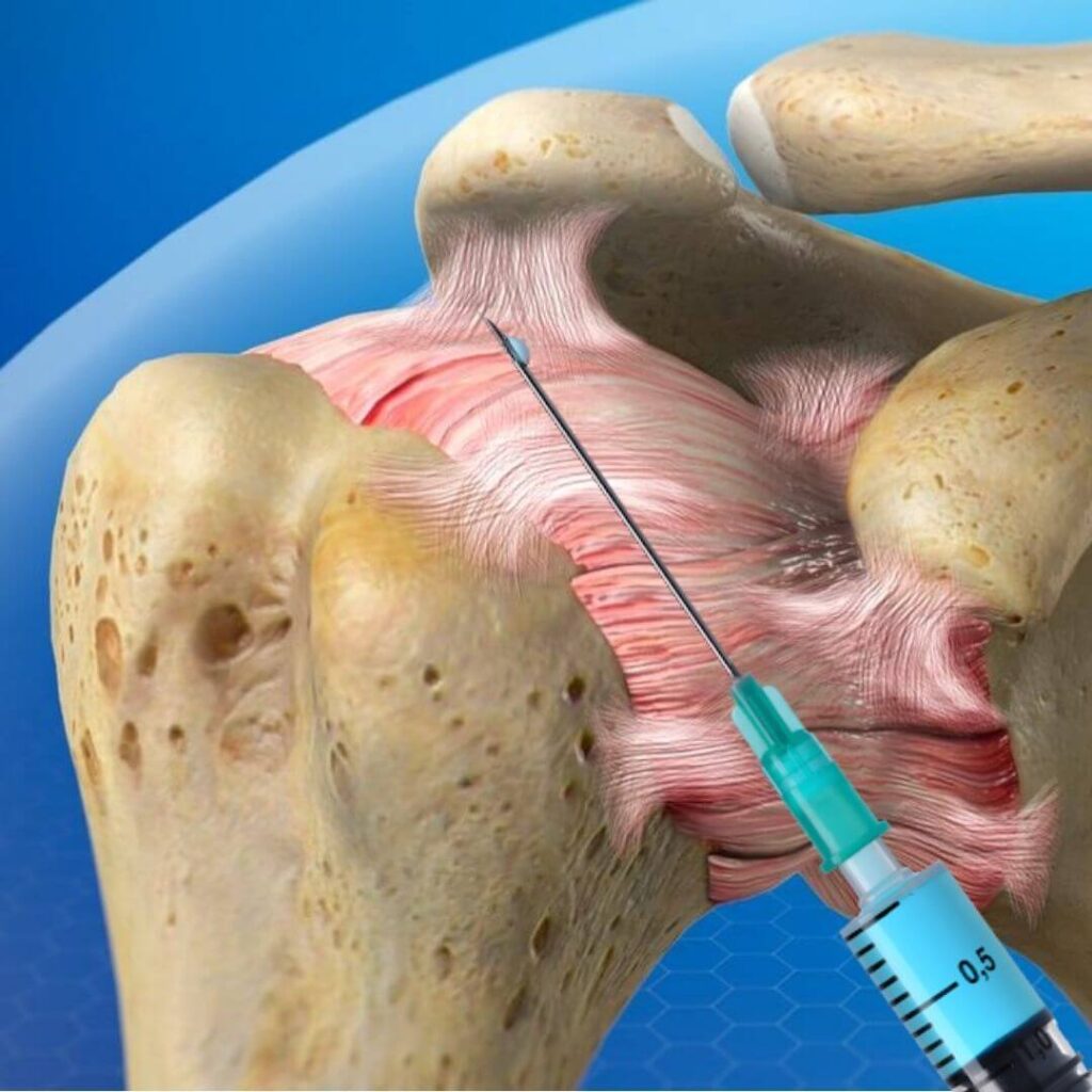 Capsulite adesiva ( Ombro congelado)